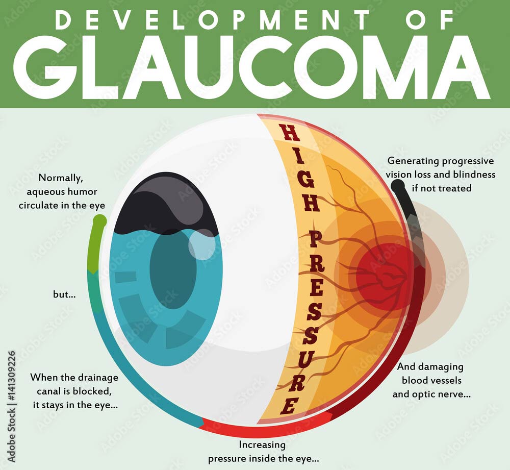 Glaucoma - Best Eye Treatment in Aligarh